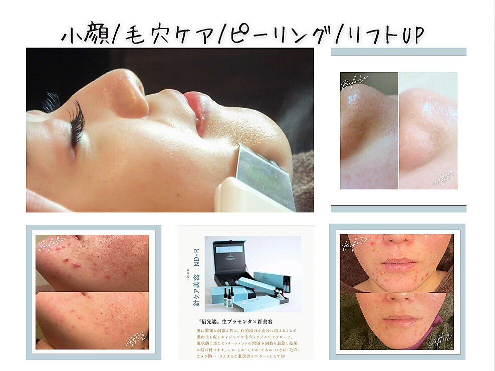 ラジオ波 キャビテーション ポレーションに関するサロン 痩身 ラジオ波 キャビテーション ポレーションに関するサロン 痩身